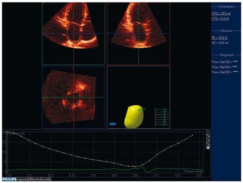 Three Dimensional Echocardiographic Assessment Of Left Atrial Size And