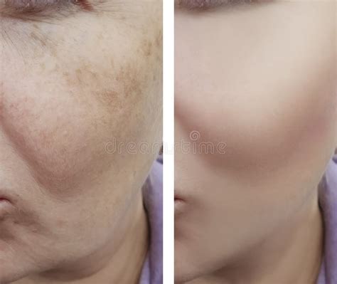 Woman Facial Wrinkles Difference Regeneration Before And After Correction Procedures Stock Image