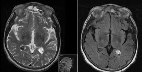 Hemorrhagic Choroid Plexus Cyst