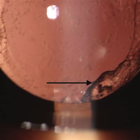 Plate Haptic Iol Showing Buckling Of Iol Arrow With Opacification Of