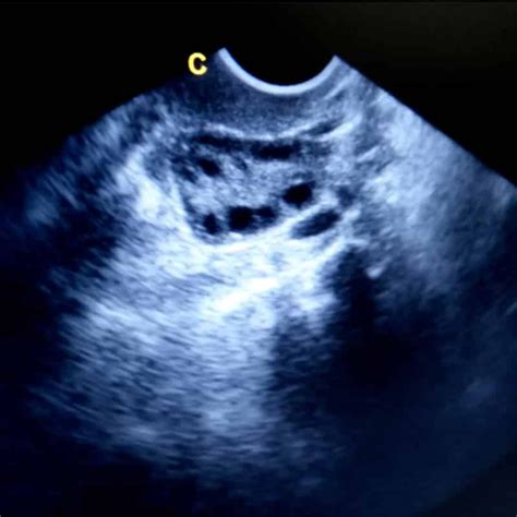 Ovary Ultrasound Normal Vs Polycystic Ovarian Syndrome Pcos Images