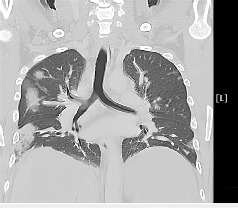 The Computed Tomography Of The Thorax Showed Multiple Nodular And Download Scientific Diagram