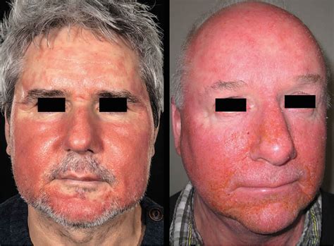 Photoallergic Contact Dermatitis Face