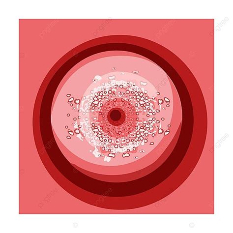 Cervical Cancer Stagesview In Female Reproductive System Biopsy Cervix Wall Vector Biopsy