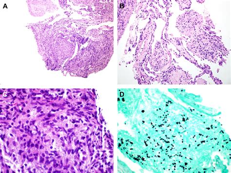 Granulomatous Lung Diseases Surgical Pathology Clinics