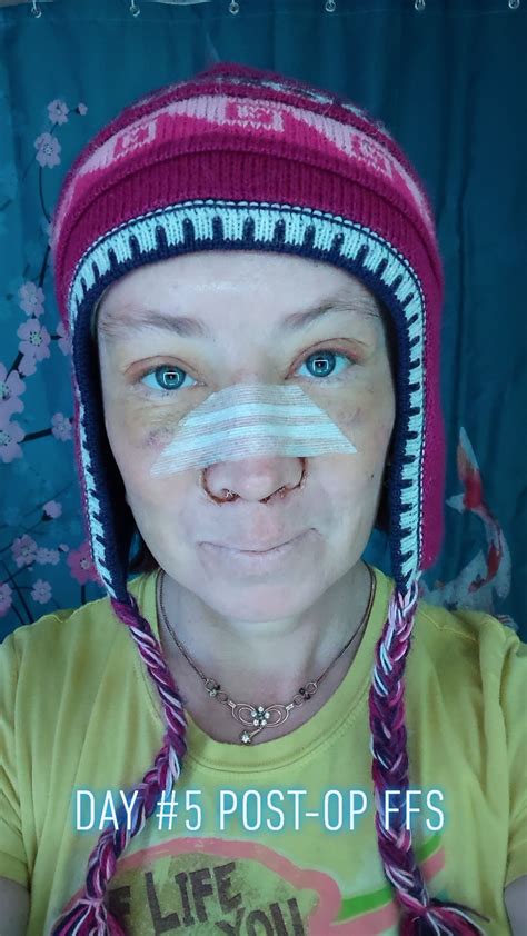 Day 5 Post Op Ffs Rtrans
