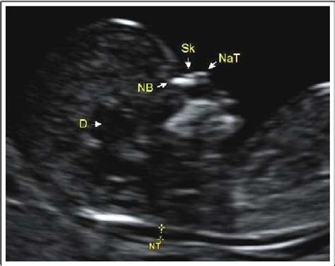Figure 1 From Quality Assessment Of Fetal Nuchal Translucency Measurements In The First