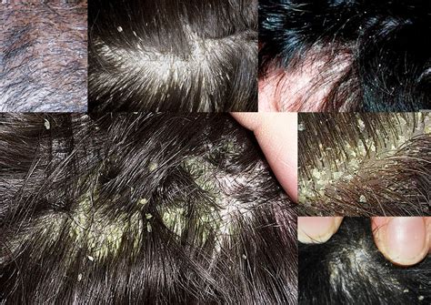 Din Ce Cauza Apar Bube In Cap Habsbdn