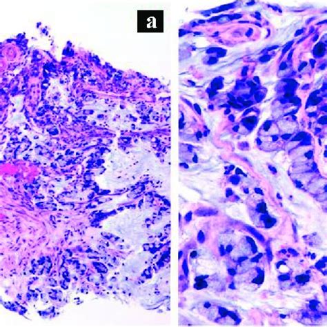 A Rectosigmoid Biopsy Hande × 100 Showing Infiltrating Malignant Download Scientific Diagram