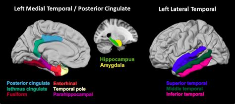 Medial Temporal Lobe Epilepsy