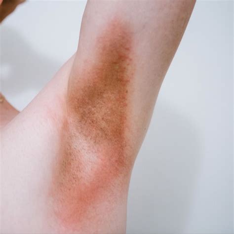 Eritrasma ascellare e inguinale cosè e quali sono i sintomi