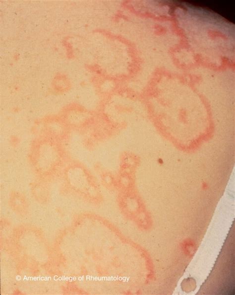 Rashes Rheumatology For Primary Care