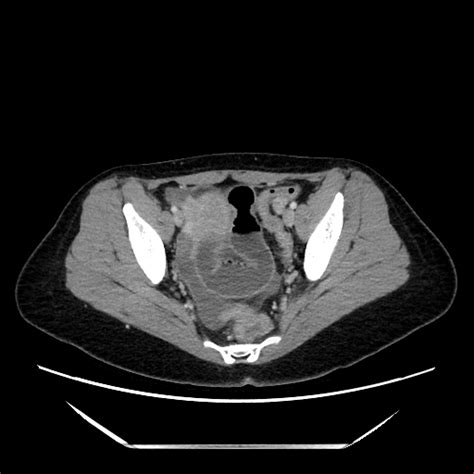 File Crohns Disease Terminal Ileitis Fistulizing Radiopaedia 98245 118784 Axial 139 Jpeg