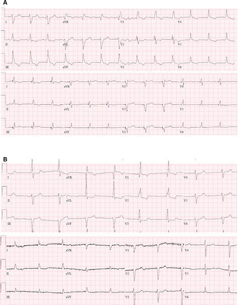 Correction Of Right Bundle Branch Block Rbbb With Axis Deviation A