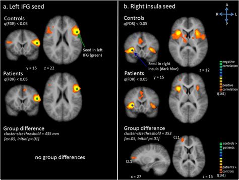 Functional Connectivity Fc Maps For The Left Inferior Frontal Gyrus Download Scientific