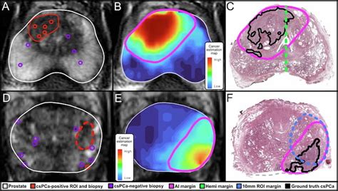 Ama Will Issue New Cpt Code For Ai Prostate Cancer Mapping Tool