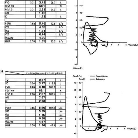 Representative Cases A Representative Spirometry Results Of Subjects