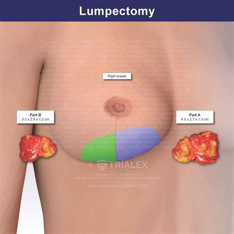 Lumpectomy Trialquest Inc