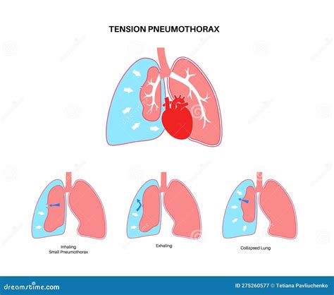 Tension Pneumothorax Poster Cartoon Vector 275008713