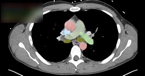 Block 2 Radiology Sagittal Plane At T4 T5 Diagram Quizlet