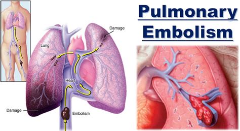 Pulmonary Embolism Diagram