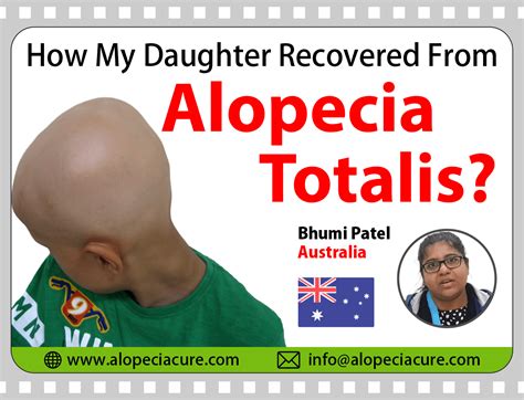 Primary Alopecia Areata