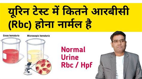 What Is Normal Urine Rbc Hpf Explained How Much Rbc Should Be In