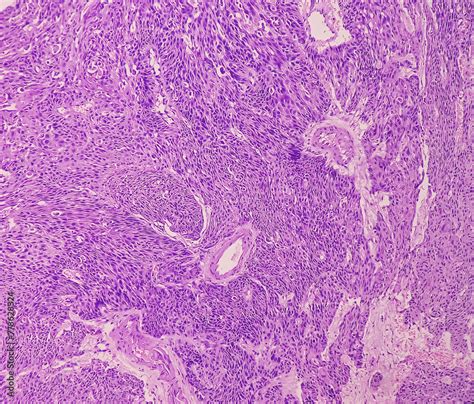 Photomicrograph Of Rectal Cancer Ibd Ibs Squamous Cell Carcinoma Of
