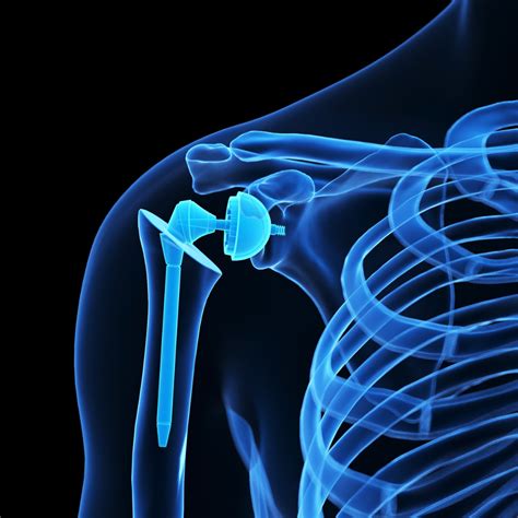 Shoulder Replacement Surgery Dr Savla