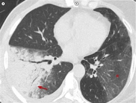 Axial Ct Scans With Lung Window Settings Showing Parenchymal Opacities