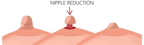 Nipple Surgery Korea Ultimate 2026 Best Correction Results