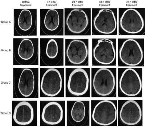 Head Computed Tomography Images Punctate Hemorrhage Was Indicated In