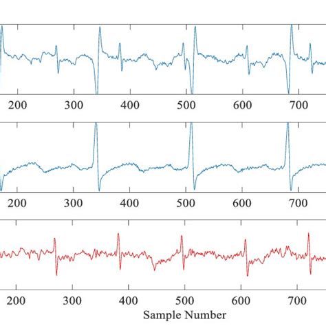 Fetal Ecg Signal Obtained By The Proposed Approach Combining The De