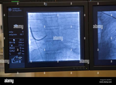 Implantable Defibrillator Surgery Angiography Being Used During