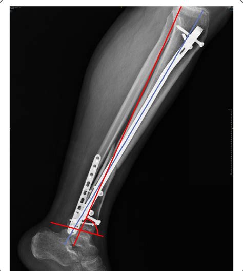 A Case Of Malalignment Following Imn Lateral View Demonstrating The Download Scientific