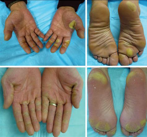 Hand Foot Skin Reaction In Cancer Patients Treated With The Multikinase Inhibitors Sorafenib And