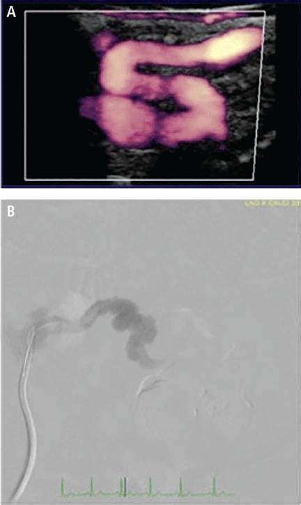 Fibromuscular Dysplasia Advances In Understanding And Management