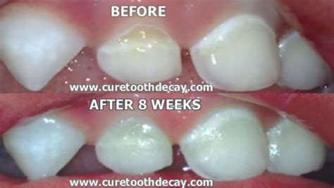 Tooth Decay Is Heal Able Simply Health Chiropractic St George