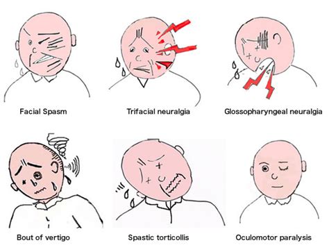 Microvascular Cranial Nerve Palsy Recovery Tiktoktoktok