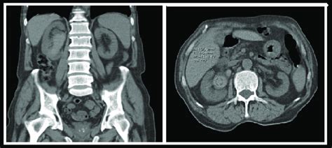 Hyperdense Space Occupying Lesion Extending From The Right Renal Pelvis Download Scientific