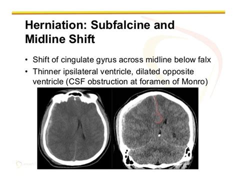 Imaging Of Traumatic Brain Injury