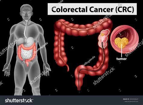Colorectal Cancer Crc Infographic Education Illustration Stock Vector