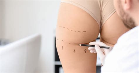 Perfecting Curves With Buttocks Liposuction In Dubai 2025