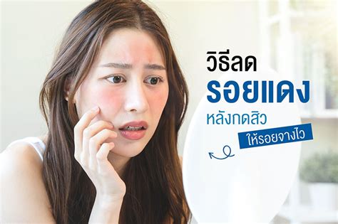 วิธีลดรอยแดงหลังกดสิว ให้รอยจางไว
