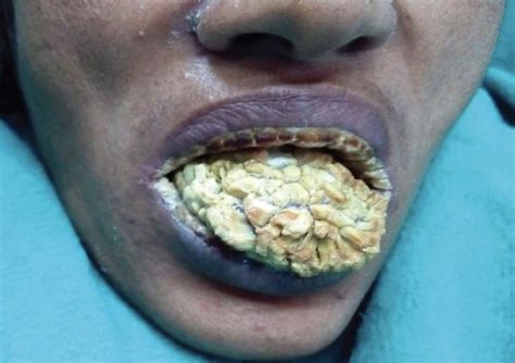 Severe Hyperplastic Oral Candidiasis In A Patient With Hiv Medizzy