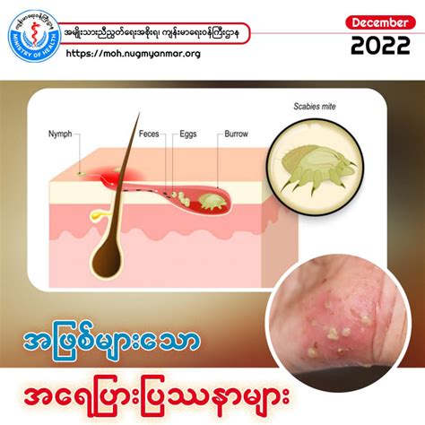 အဖြစ်များသော အရေပြား ပြဿနာများ ဒီဇင်ဘာလ၊ ၂၀၂၂ ခုနှစ် Ministry Of Health Moh Myanmar