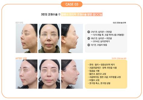 코재수술 코성형 별성형외과의원