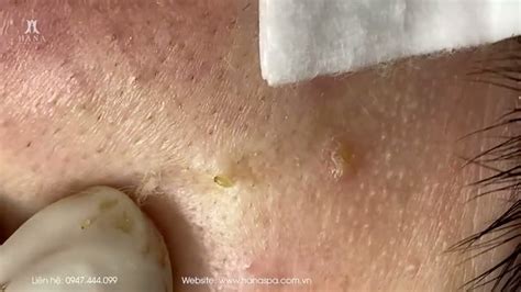Bhaint Blackheads