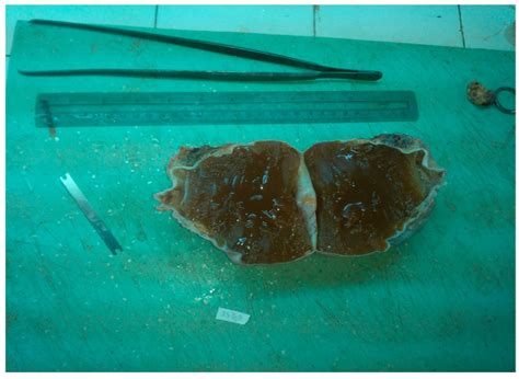 Struma Ovarii During Pregnancy Pmc