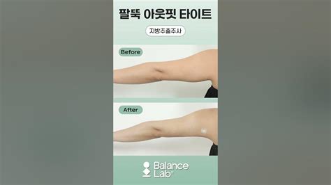 팔뚝아웃핏 주사 2주차 후기 팔뚝살빼기 팔지방흡입 지방추출주사 지방흡입 밸런스랩성형외과 Youtube